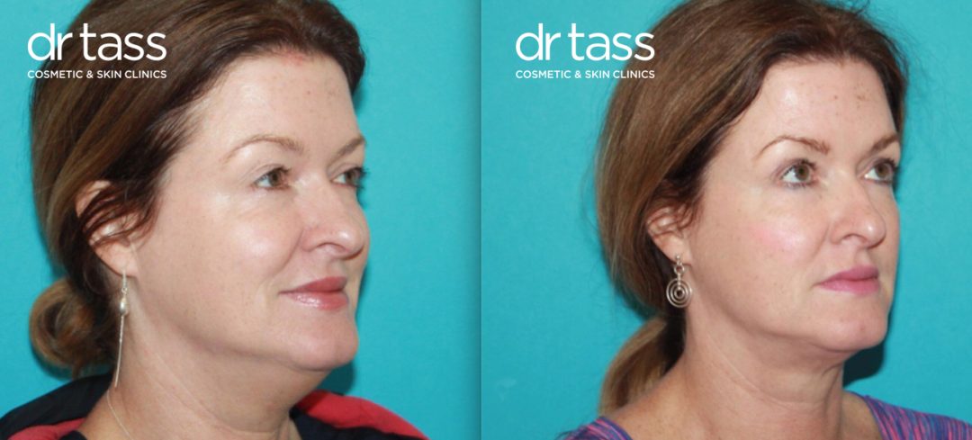 Double Chin Reduction Treatment Melbourne - Dr Tass