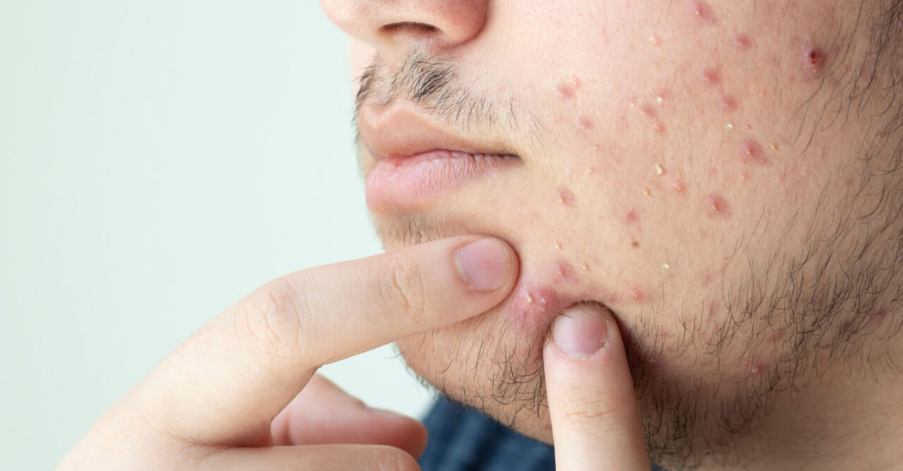 How Can I Reduce Acne Scarring? - Dr Tass